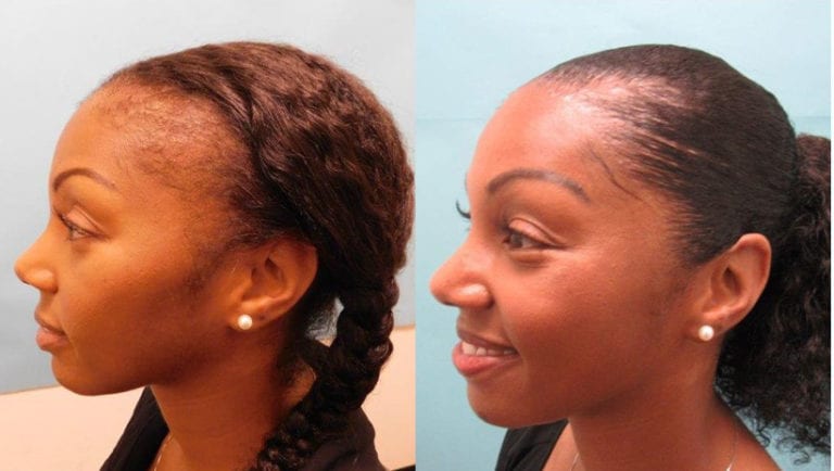 Traction Alopecia Case Study - Hair Loss At Edges - Hair Transplant ...