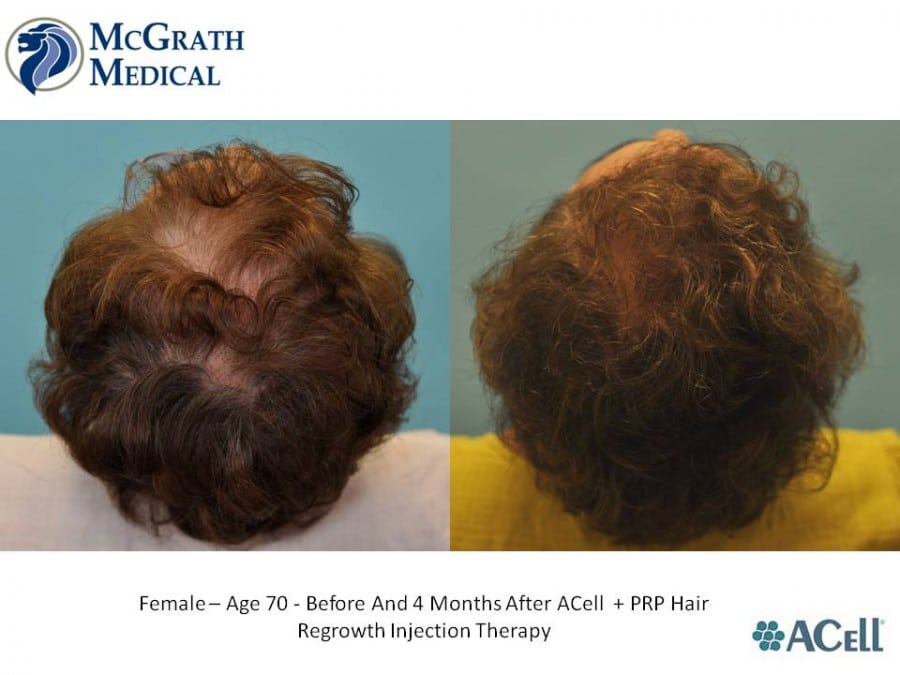 ACell + PRP Hair Regrowth Injection Therapy for Women in Austin, Texas (TX)